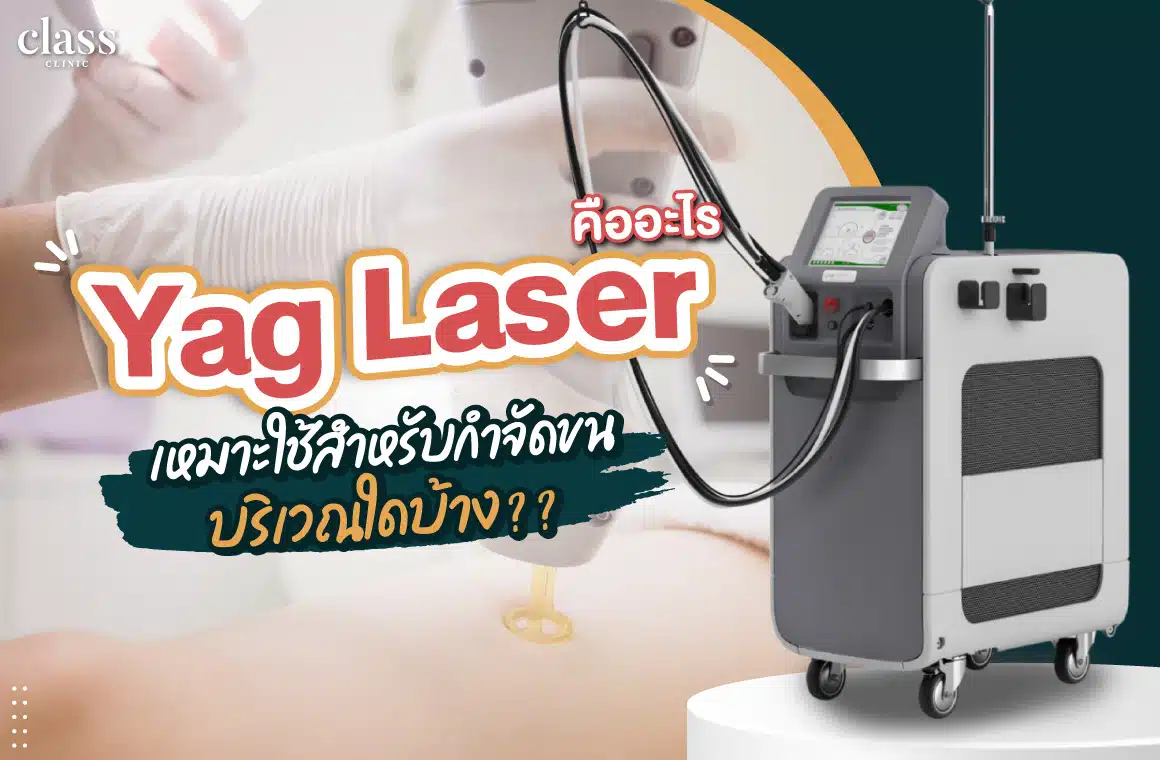 yag laser คืออะไร - Classclinic