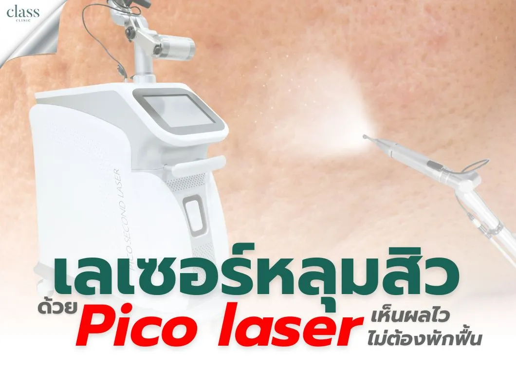 เลเซอร์หลุมสิวโคราช ด้วย Pico Laser เห็นผลไว ไม่ต้องพักฟื้น - Classclinic